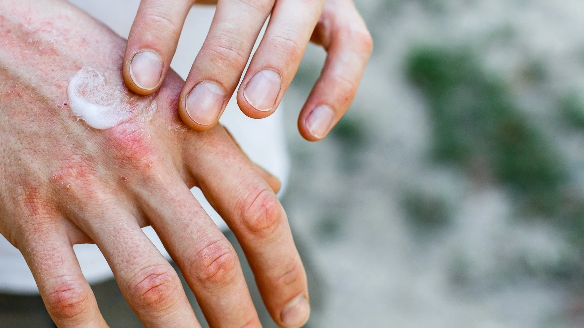 Last van droge handen in de winter? Dit kun je doen – Gladskin Europe